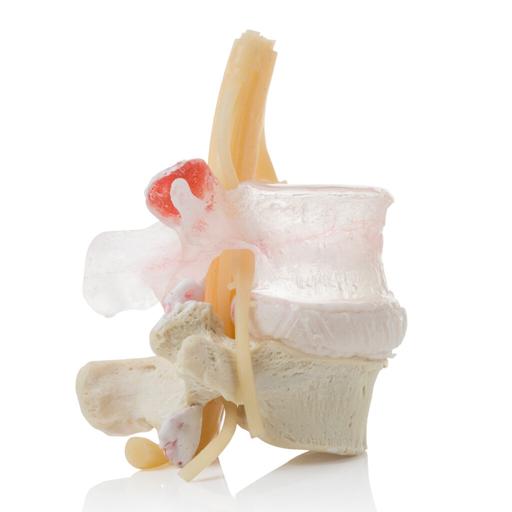 Professional Lumbar Dynamic Disc model | Spine Store