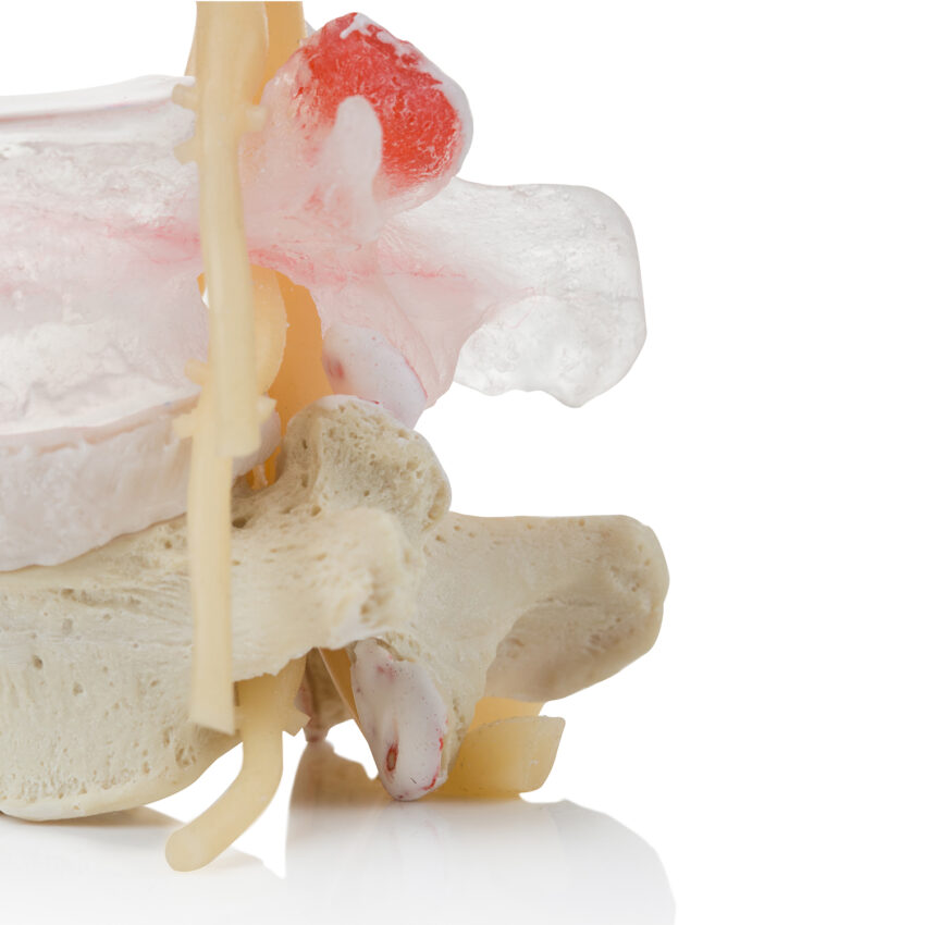 Professional Lumbar Dynamic Disc model | Spine Store